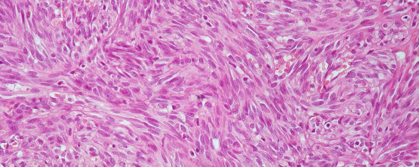 Sarcome de Kaposi : informations et traitements - Institut Pasteur