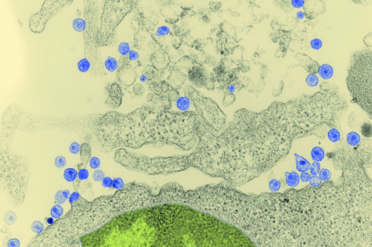 40 years of HIV discovery: the virus responsible for AIDS is identified ...